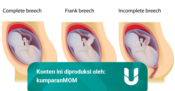 Mengenal 3 Jenis Posisi Sungsang pada Janin | kumparan.com