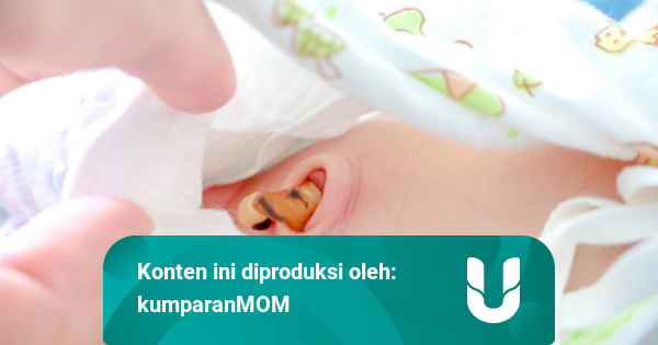 Ciri-ciri Tali Pusat Bayi Baru Lahir Mengalami Infeksi - kumparan.com