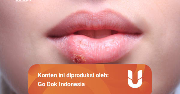 Faktor yang Menjadi Penyebab Munculnya Jerawat di Bibir - kumparan.com